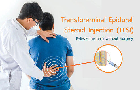 Transforaminal Epidural Steroid Injection (TESI), Relieve the pain ...